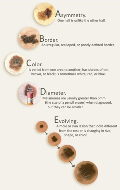 SKIN CANCER | FW Dermatology